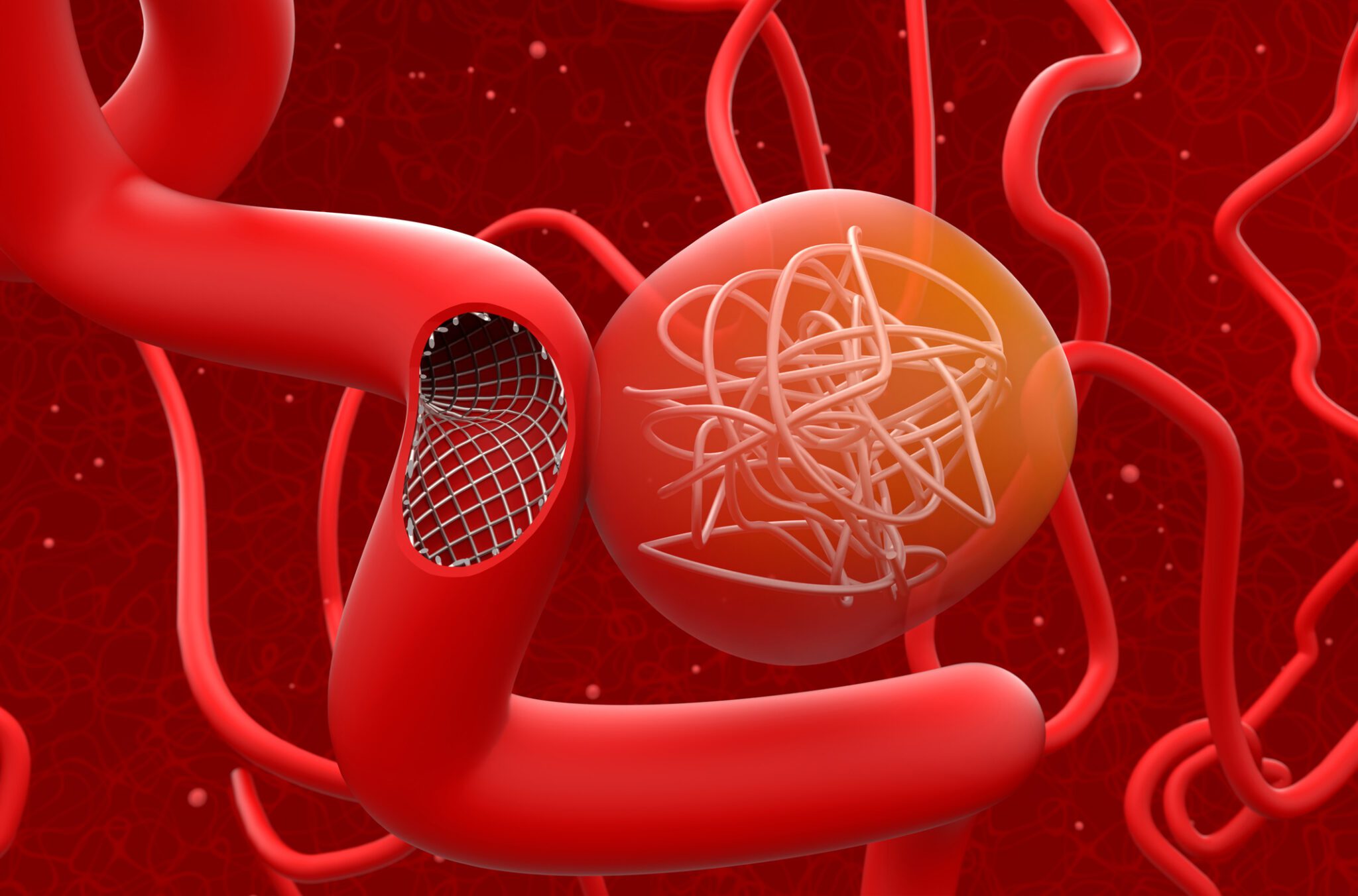 Radiopaque Materials For Flow Diverters: Boosting Visibility And Safety ...