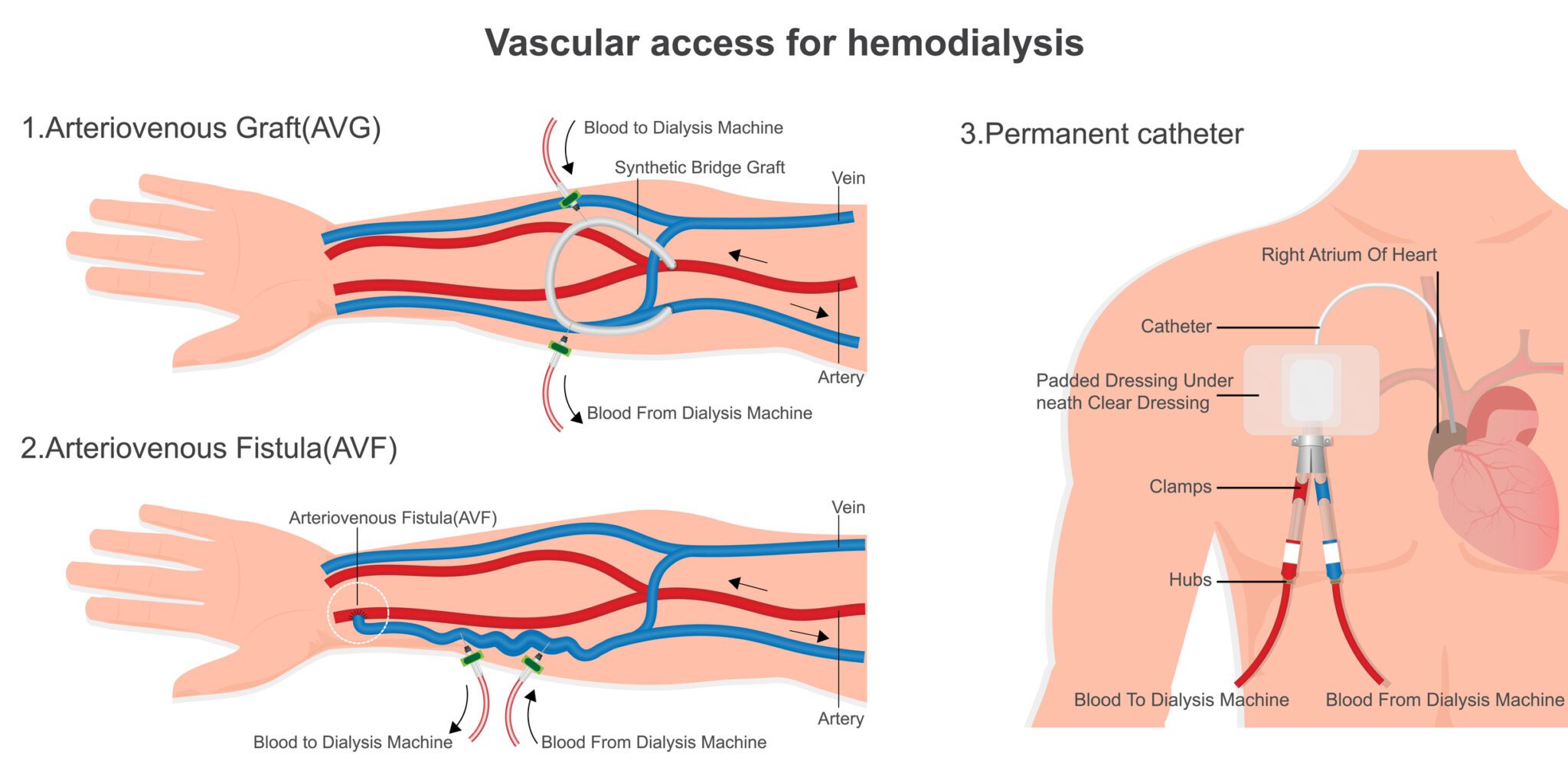 Arteriovenous (AV) Grafts & Fistula Access Devices: Lifelines in Hemodialysis Care - Smart Reactors